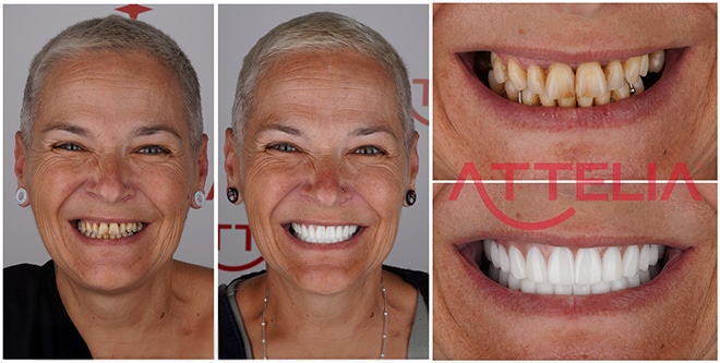 Dental Implants in Turkey | New Teeth Turkey | Dentist In Turkey