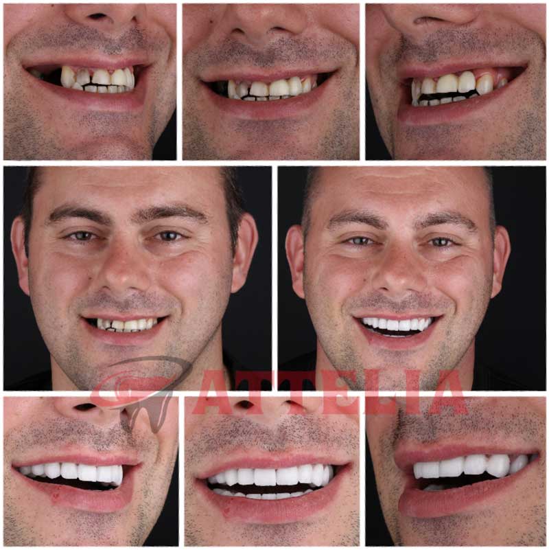 Before & After | New Teeth Turkey