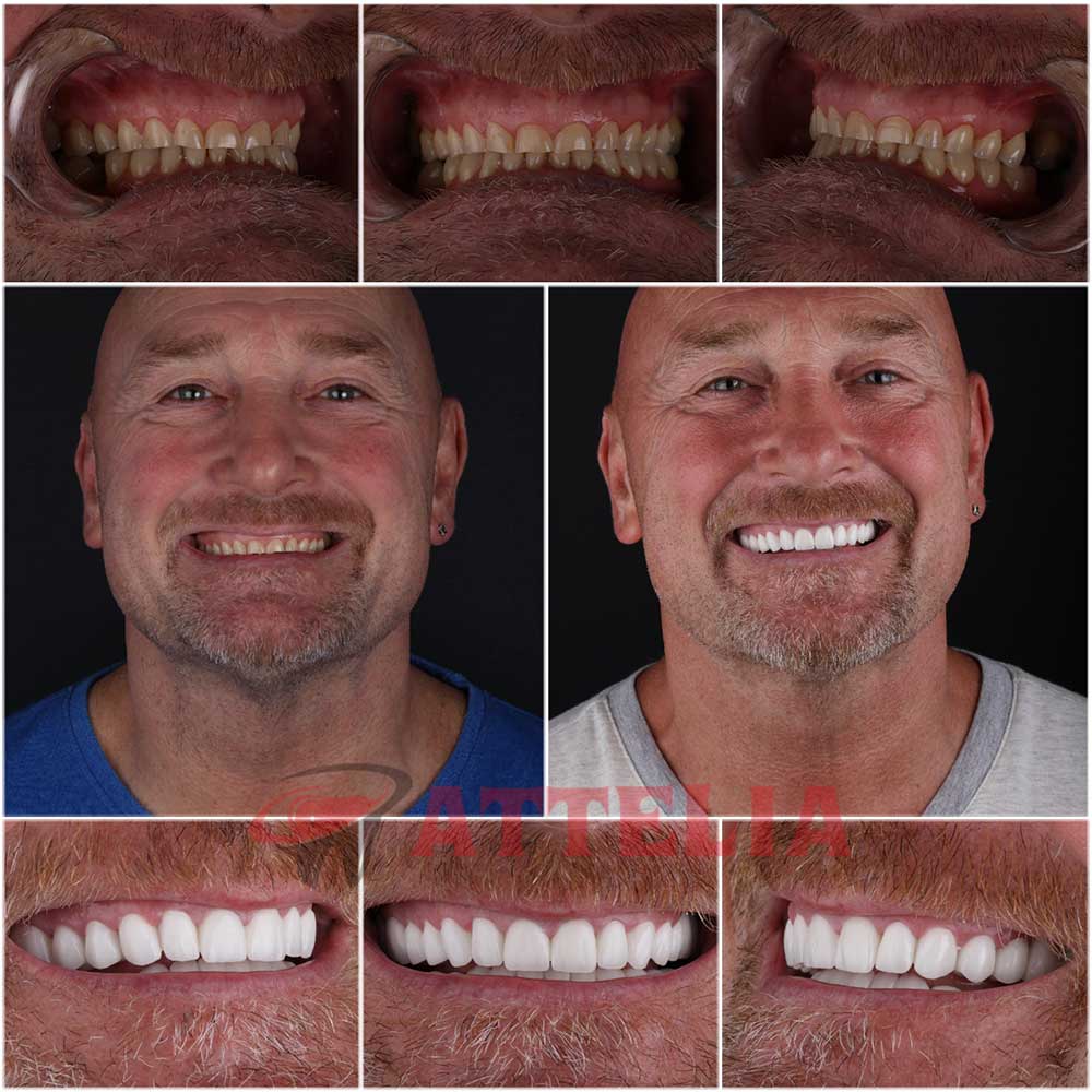 Before & After | New Teeth Turkey