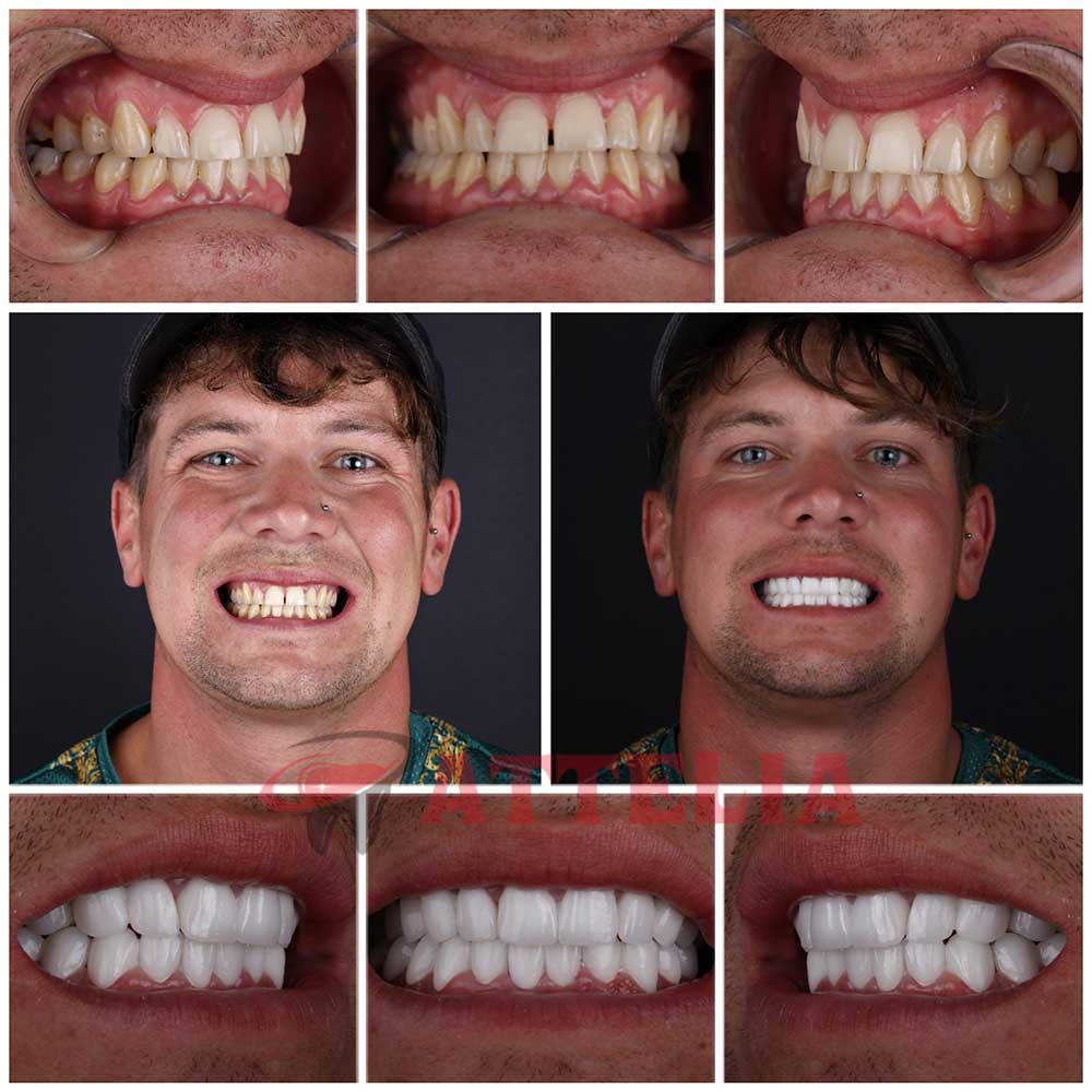 Before & After | New Teeth Turkey