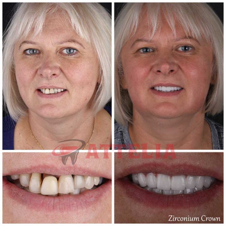 Before & After | New Teeth Turkey