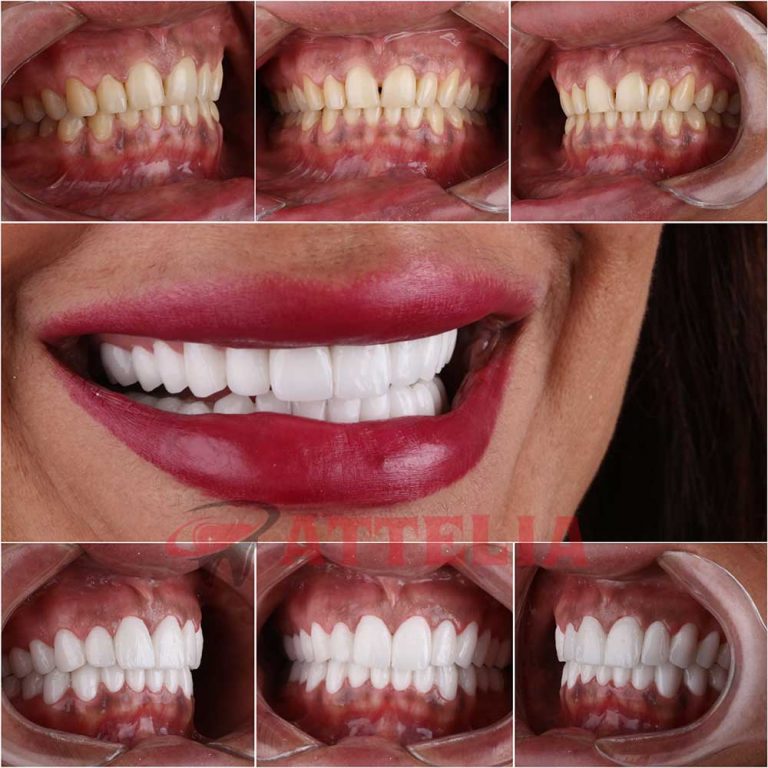 Before & After | New Teeth Turkey