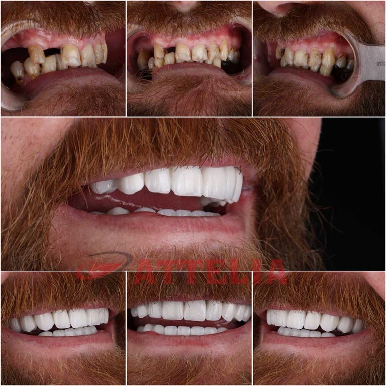 Before & After | New Teeth Turkey