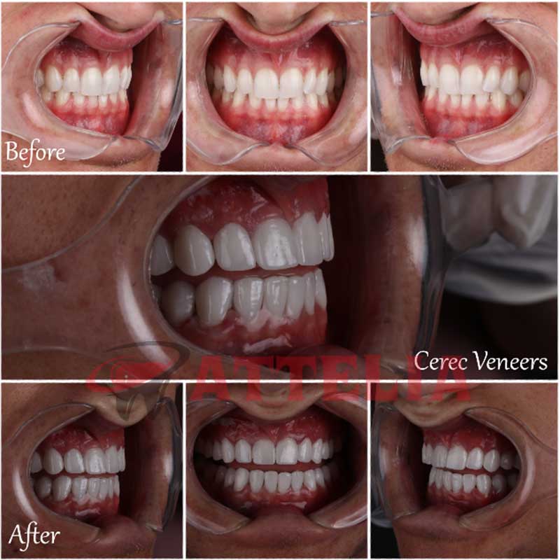 Before & After | New Teeth Turkey