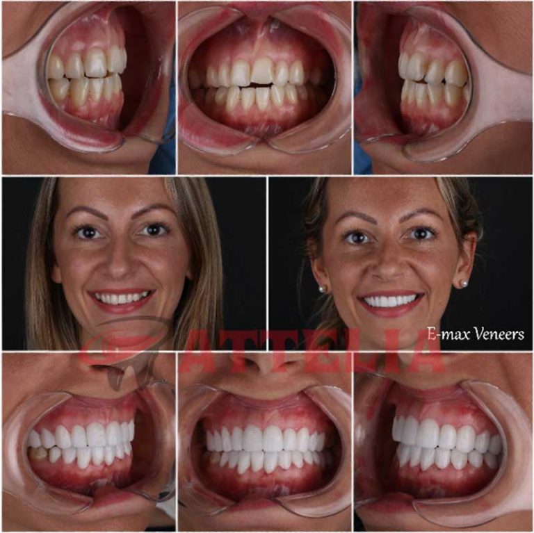 Before & After | New Teeth Turkey
