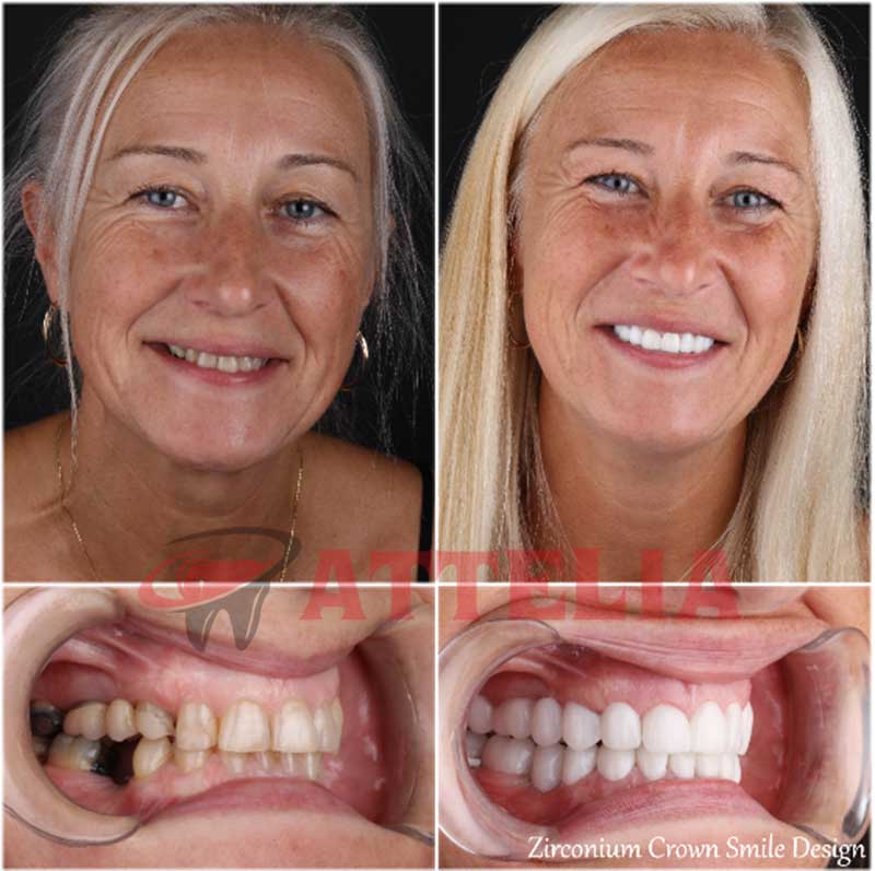 Before & After | New Teeth Turkey