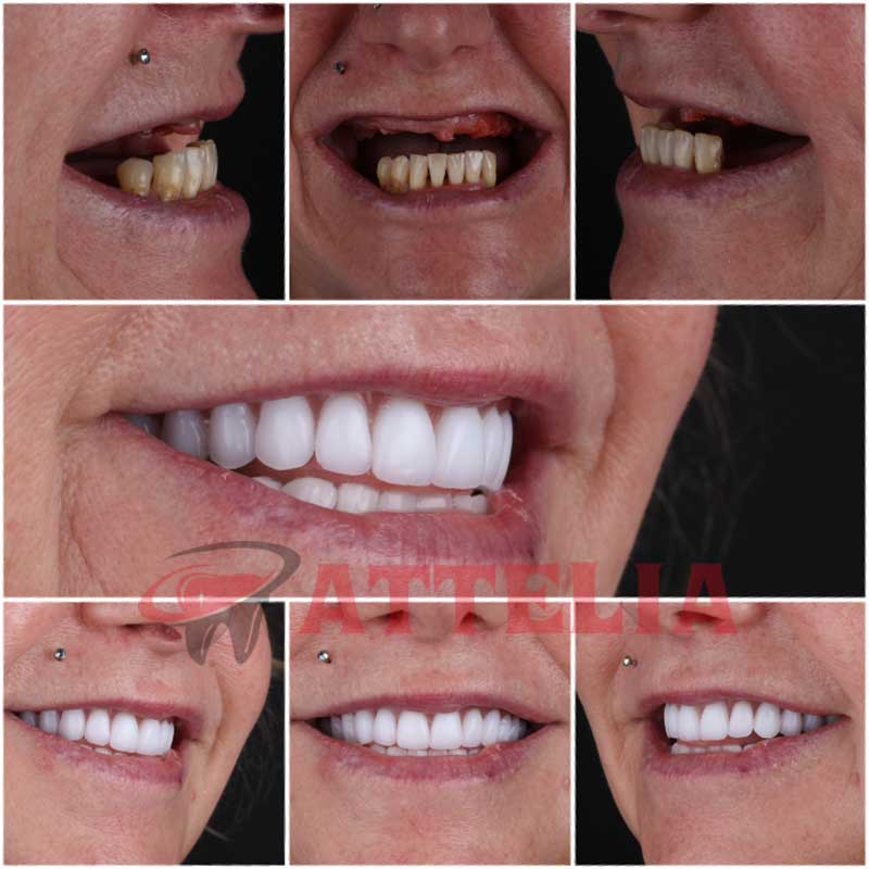 Before & After | New Teeth Turkey