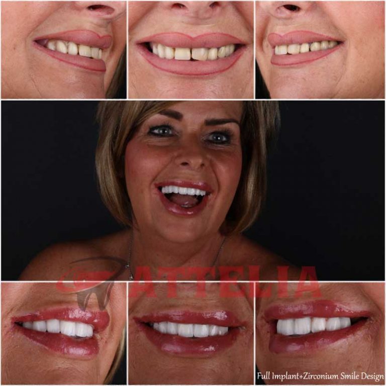 Before & After | New Teeth Turkey
