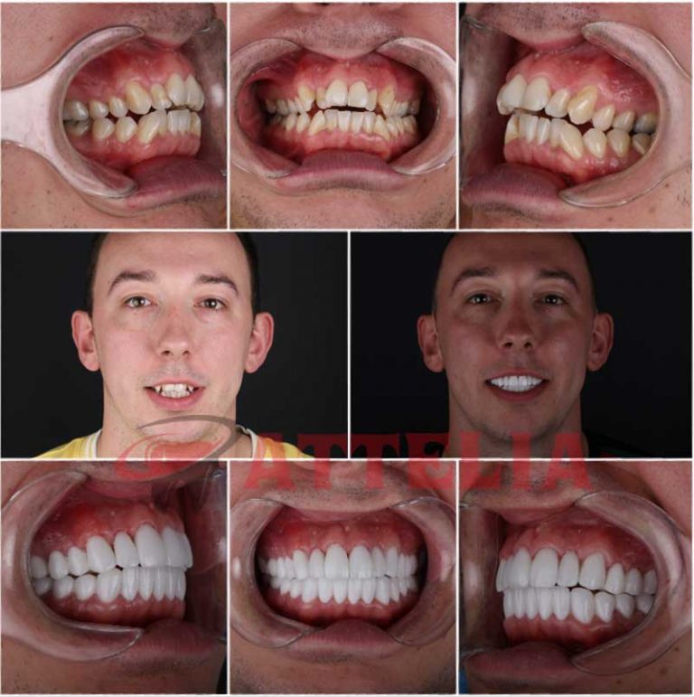 Before & After | New Teeth Turkey