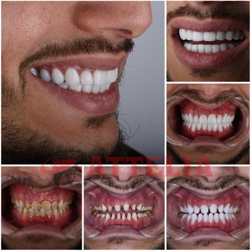 Before & After | New Teeth Turkey