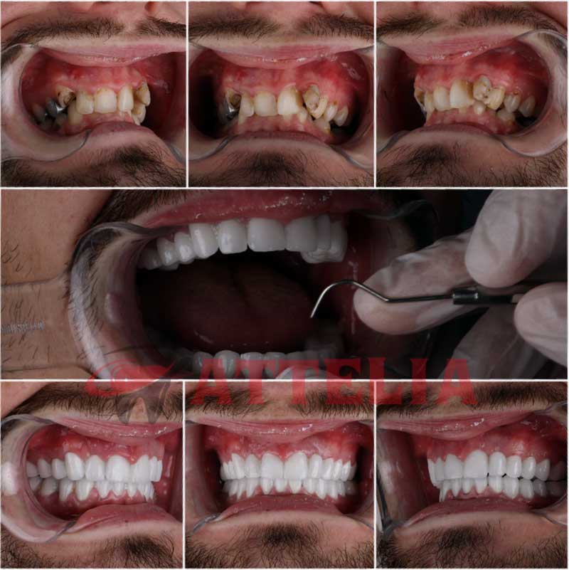 Before & After | New Teeth Turkey