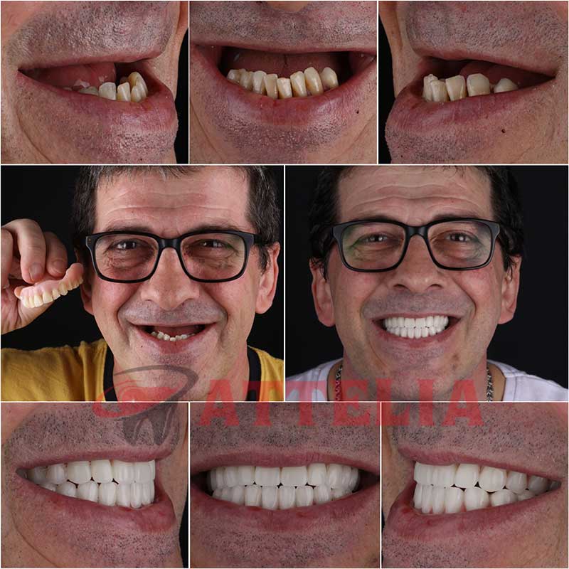 Before & After | New Teeth Turkey