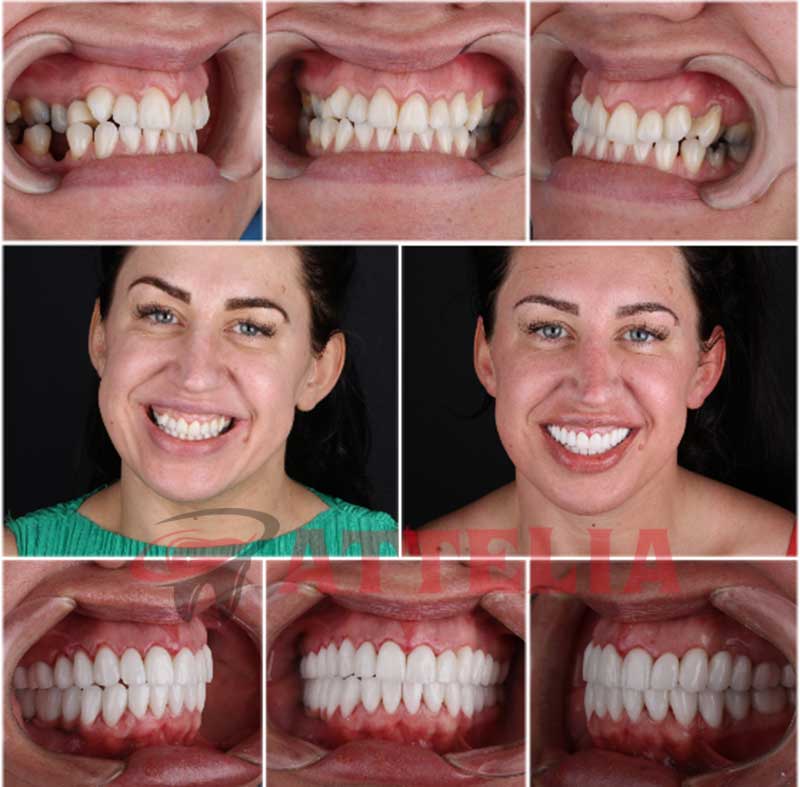Before & After | New Teeth Turkey