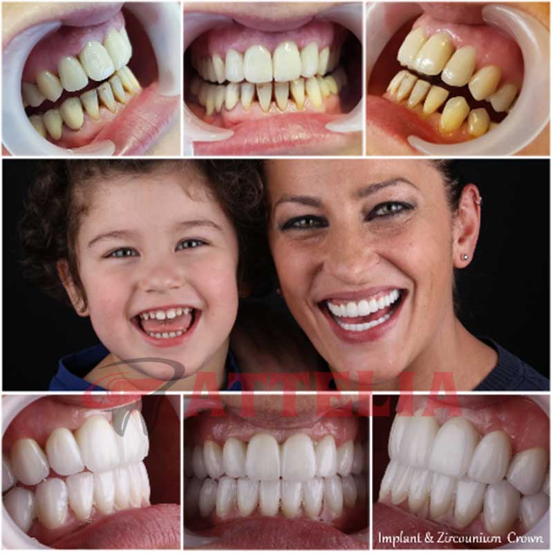 Before & After | New Teeth Turkey
