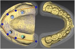 Dental Implants in Turkey | New Teeth Turkey | Dentist In Turkey